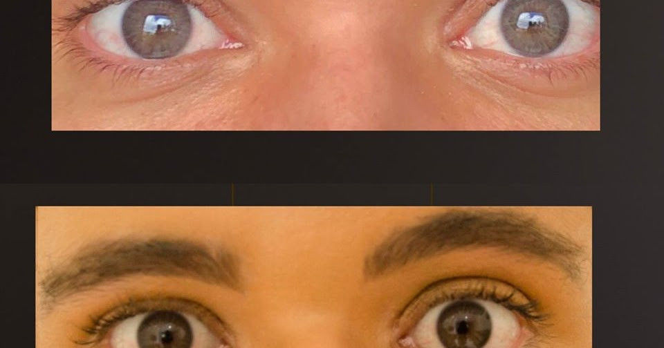 Laser Surgery Helps to Change Eye Color Permanently