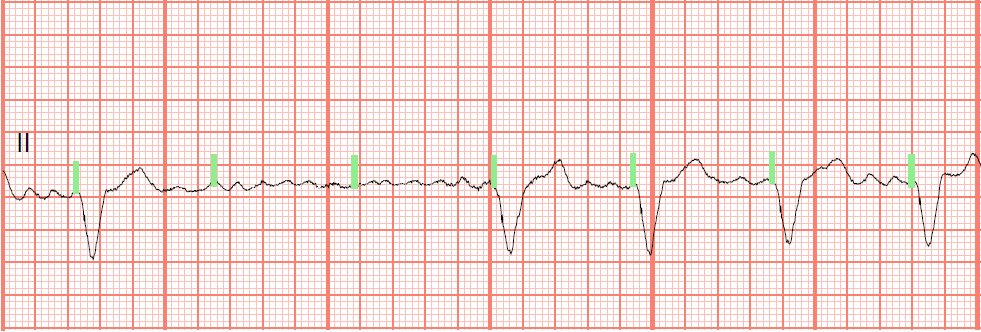 EKG Quiz 318