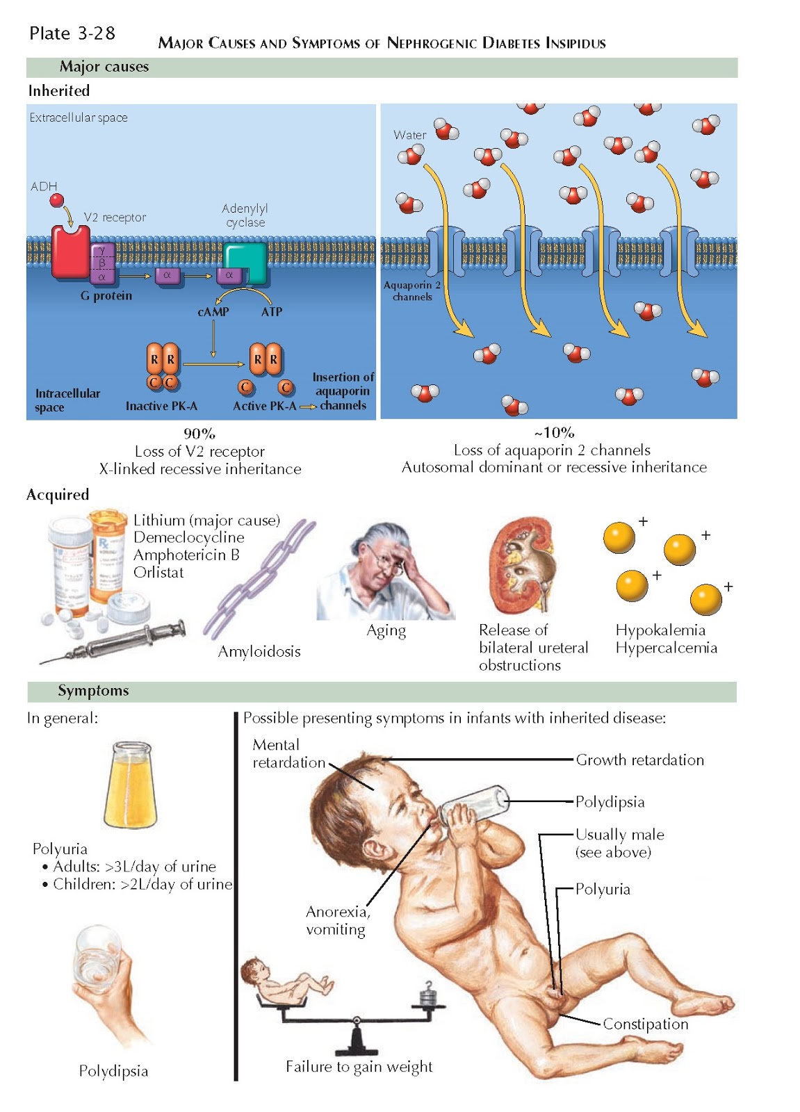 NEPHROGENIC DIABETES INSIPIDUS Pediagenosis nephrogenic-diabetes-insipidus-pediagenosis