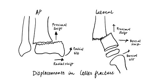 Medicowesome: Distal Radius Fracture Reduction