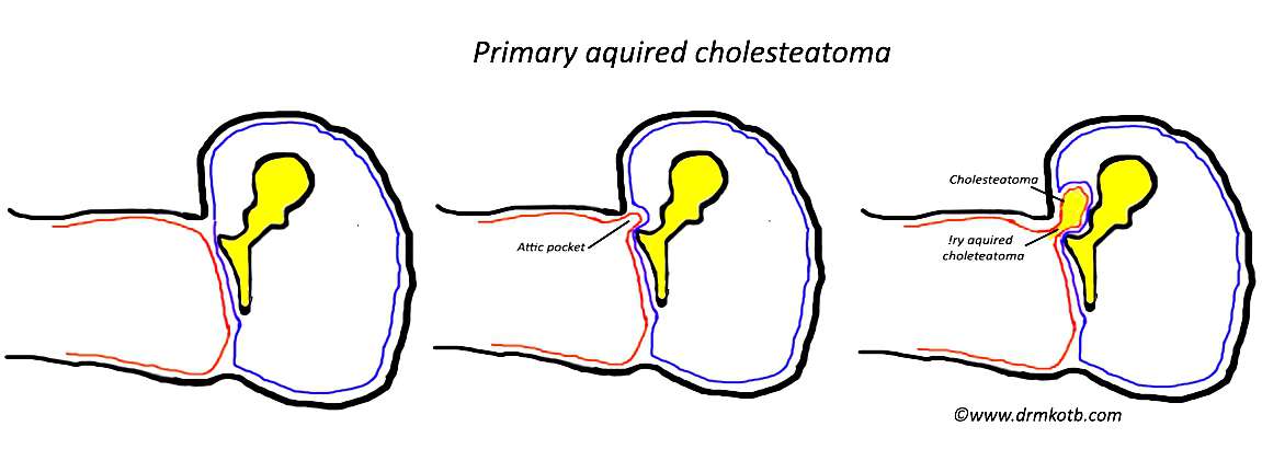 MBBS DOCTORS: Atticoantral Chronic Suppurative Otitis Media