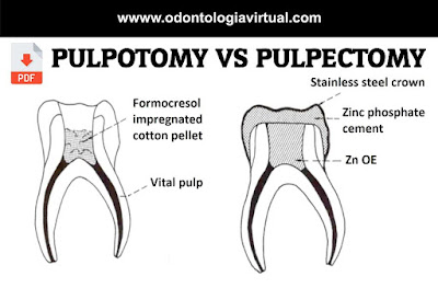 PDF: Pulpotomy versus pulpectomy in the treatment of vital pulp ...