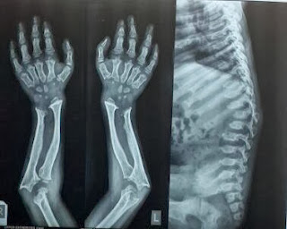 Mucopolysaccharidosis (MPS)-Xray Diagnosis - Sumer's Radiology Blog