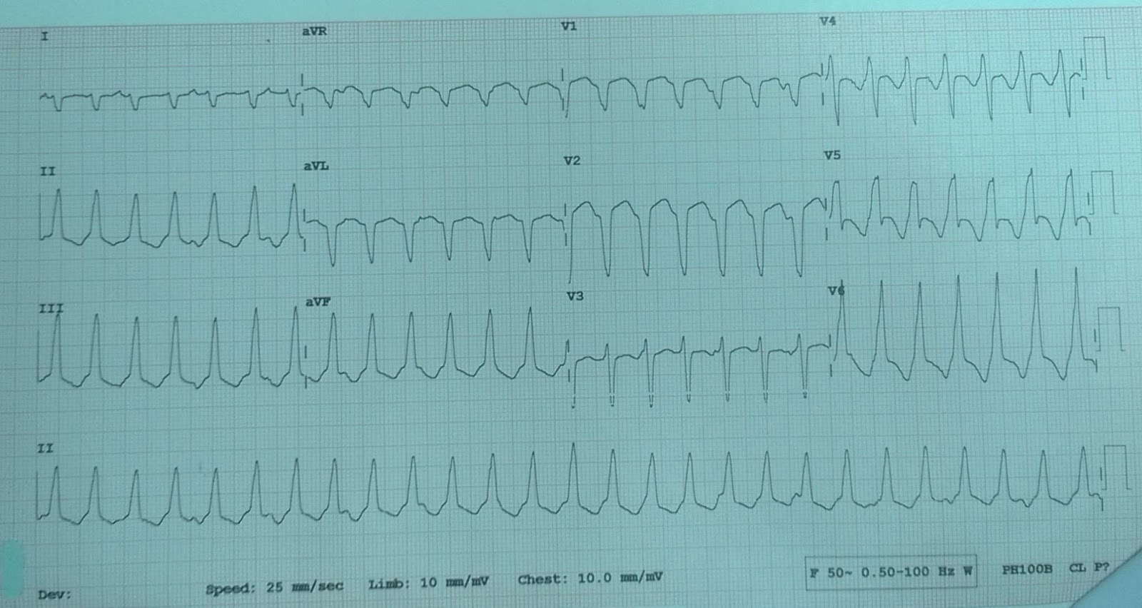 Cardiology window: Monomorphic Ventricular tachycardia ? What is your ...