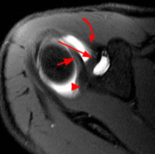 MRI Musculo-Skeletal Section: Glenohumeral ligaments