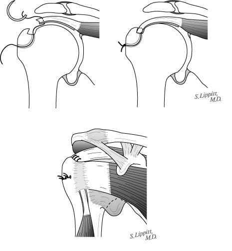 UW Shoulder and Elbow Academy: Rotator Cuff 13 - Full thickness rotator ...