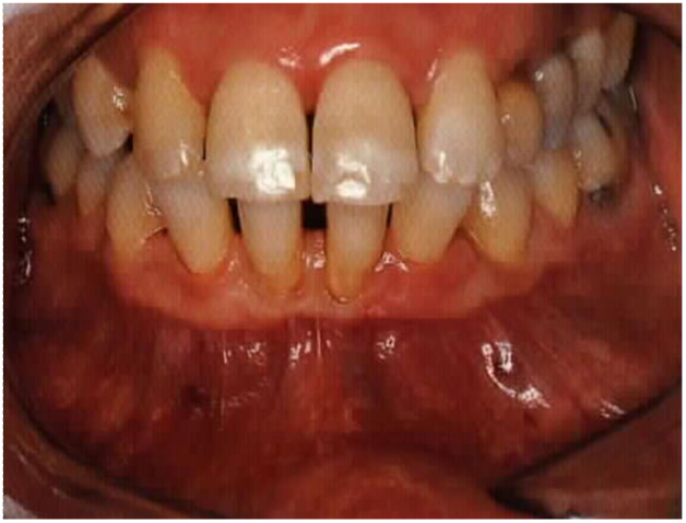Dentistry and Medicine: Surgical management of Unerupted and Impacted teeth