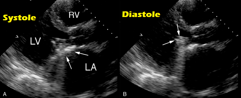 Starr Edwards Mitral Prosthesis on Echocardiography