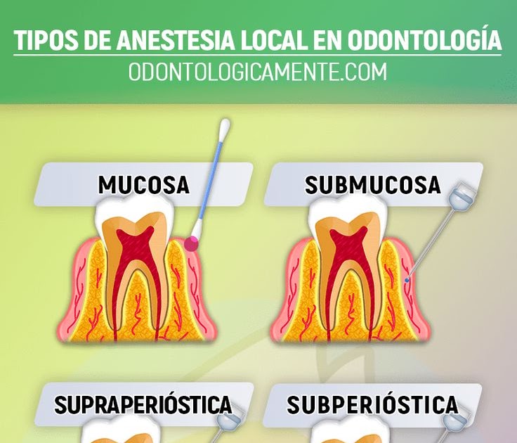 Tipos de anestesia local en odontología (Infografía)