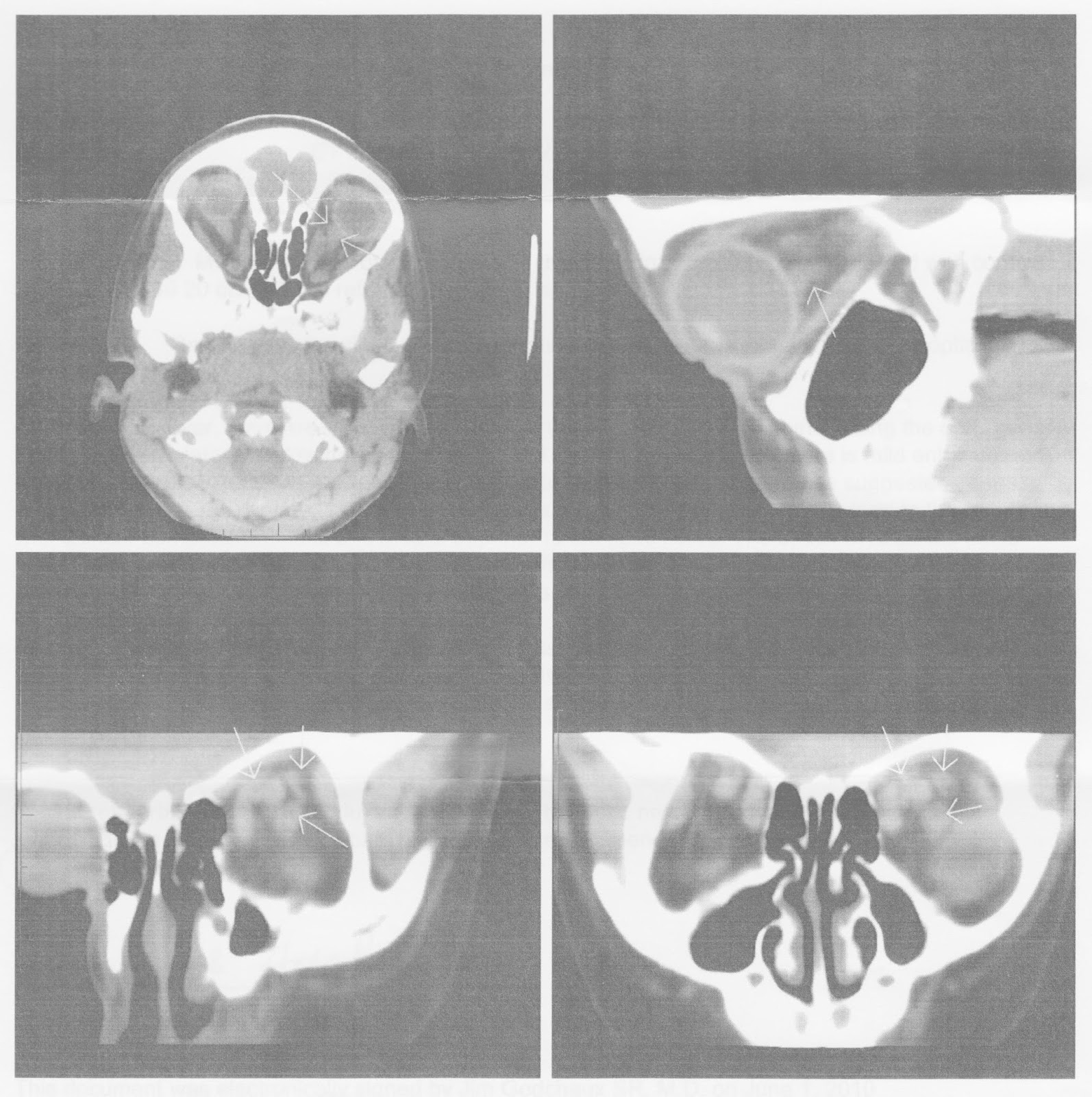 Lexie's Lymphangioma