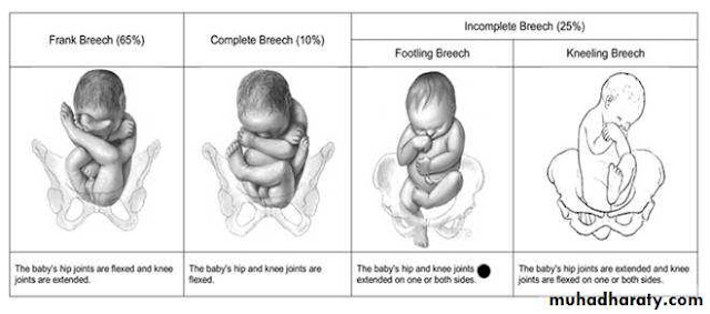 Med4yu: Primary Dysfunctional Labor