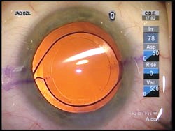 What You Need To Know Before Cataract Surgery in 2016 - Eyedolatry
