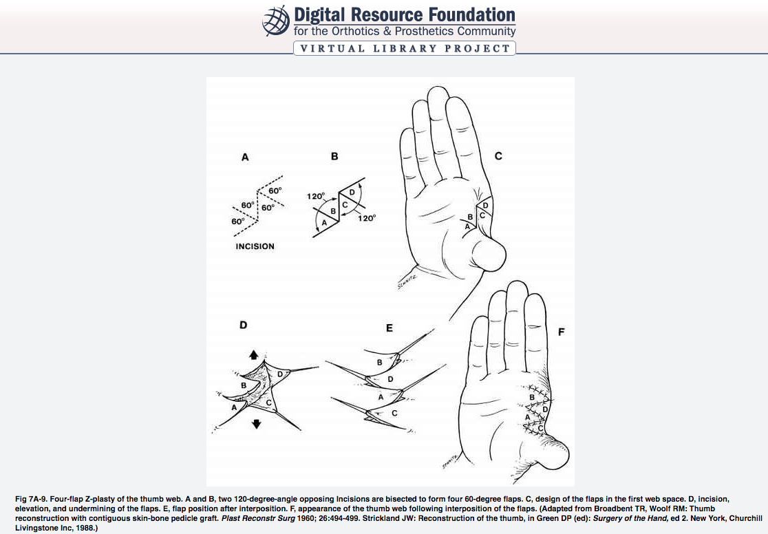 Skin Contracture and Z-plasty Correction | Congenital Hand and Arm ...