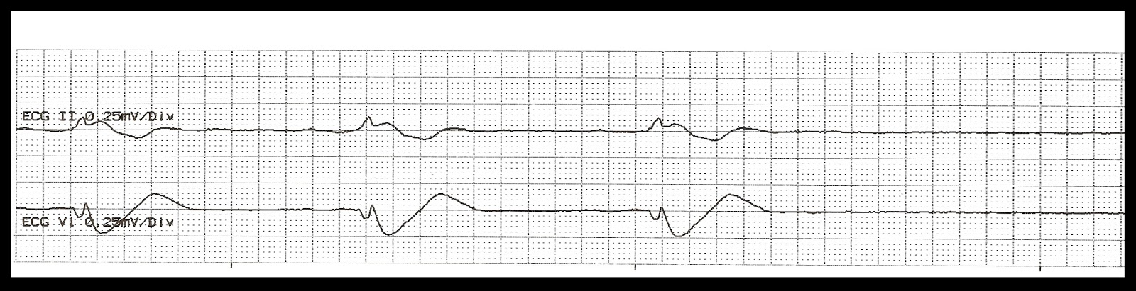ACLS review: Pulseless Electrical Activity- part 1