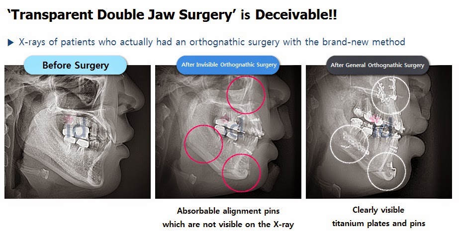 ID Hospital Korea: No one will know that you had double jaw surgery ...