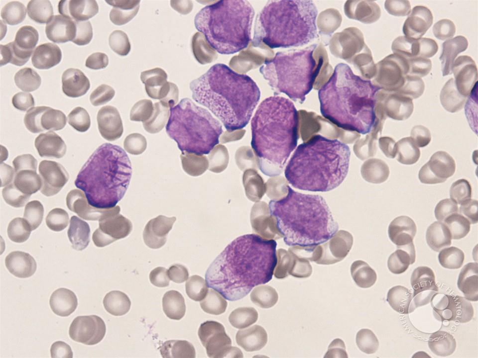 VETERINARY HEMATOLOGY DEXTERVET: AML-M3 faggot cell