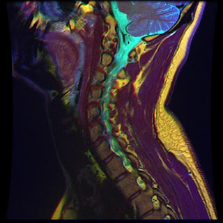 Nevit's blog: Color MRI of Cervical vertebrae