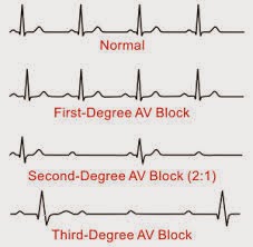 Cardiac arrhythmia - important samples