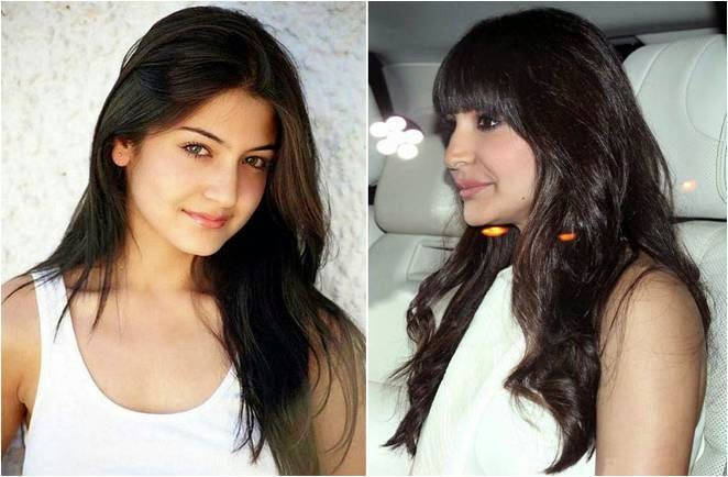 Anushka Sharma Plastic Surgery
