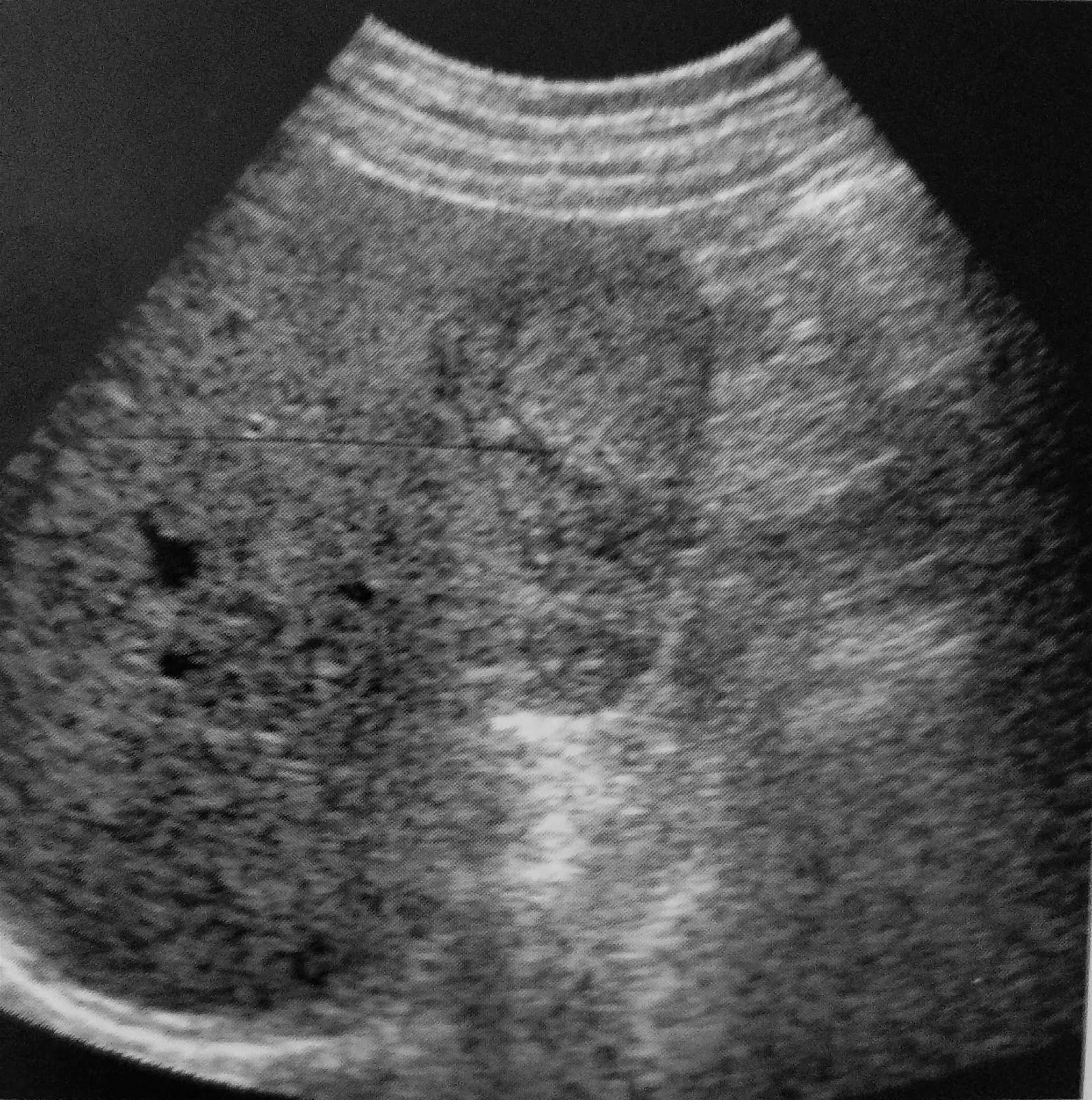 What is Biliary sludge? - Health and Nutrition