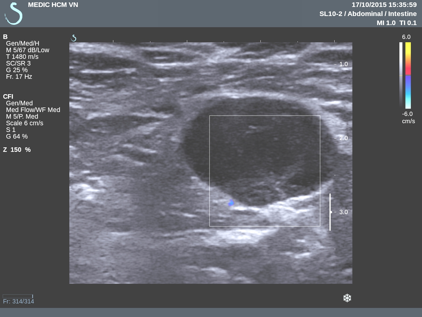 VIETNAMESE MEDIC ULTRASOUND: CASE 343: TB AXILLARY NODES, Dr PHAN THANH ...