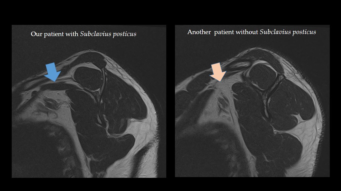 Ultimate Radiology : Subclavius Posticus ! - An accessory muscle of the ...