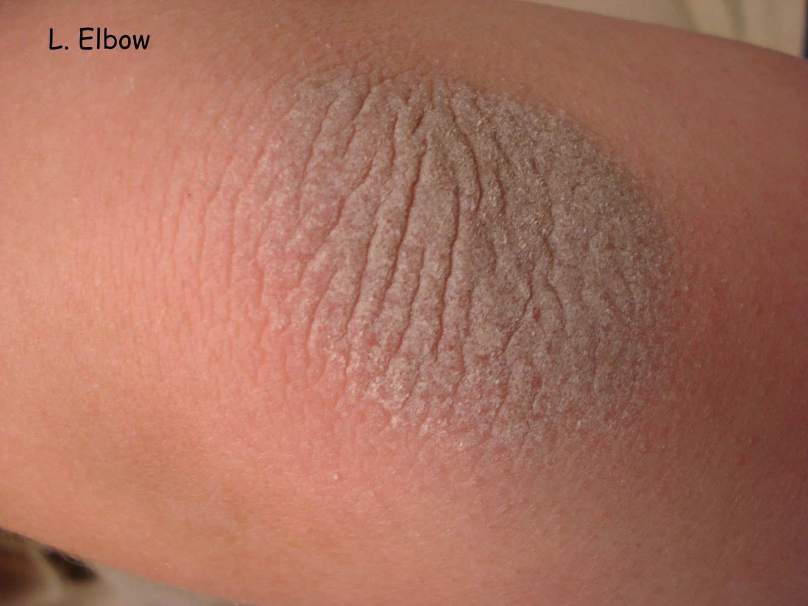 VIRTUAL GRAND ROUNDS IN DERMATOLOGY 2.0: FADES