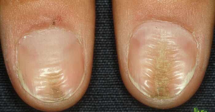 Salute e bellezza: Cosa fare per un'unghia annerita dopo un trauma