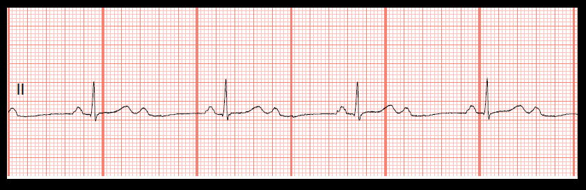 Various 2nd Degree Heart Block Type II