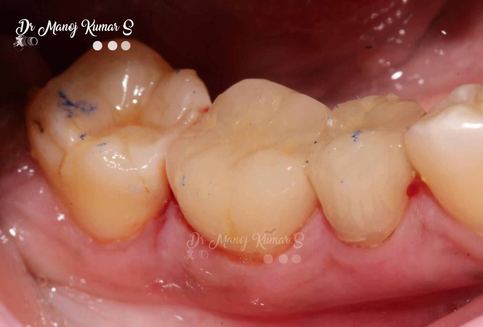 Case 45: Cementation protocol for an emax- lithium disilicate crown