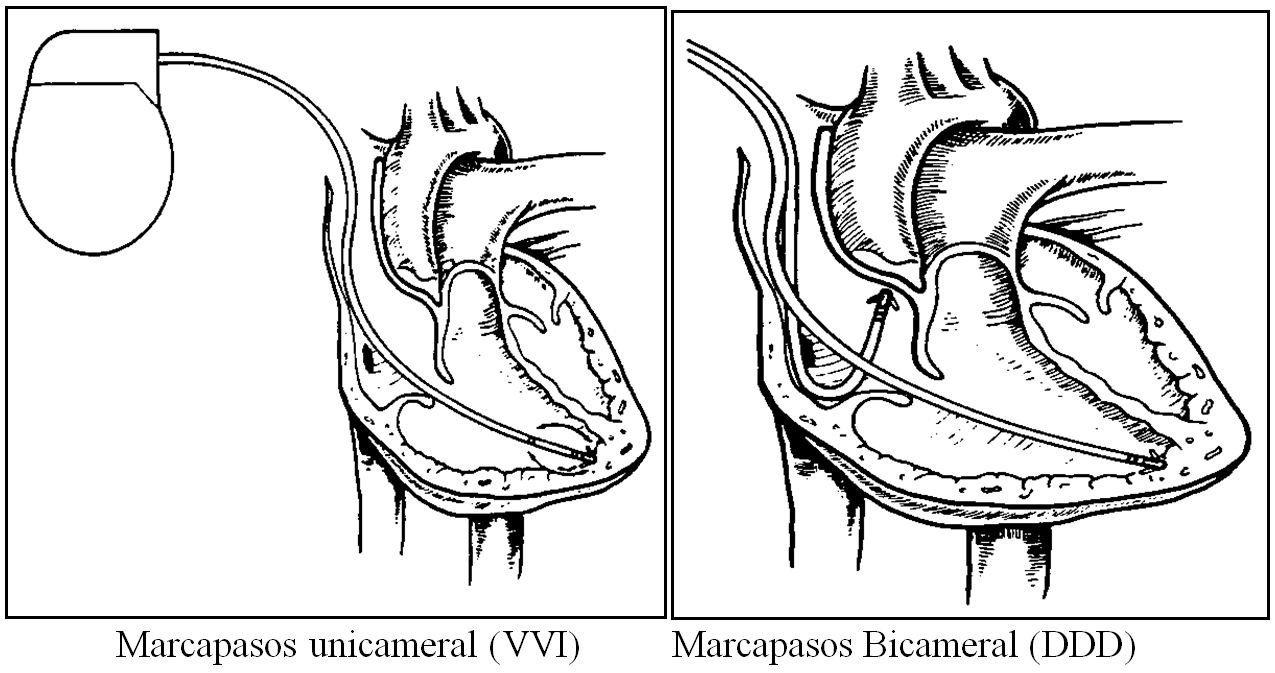 Enfermer@ en Urgencias y UCI : Técnica XIII: Inserción de un Marcapasos ...