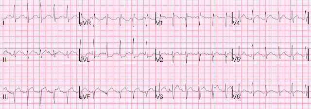 Pulmonary Embolism