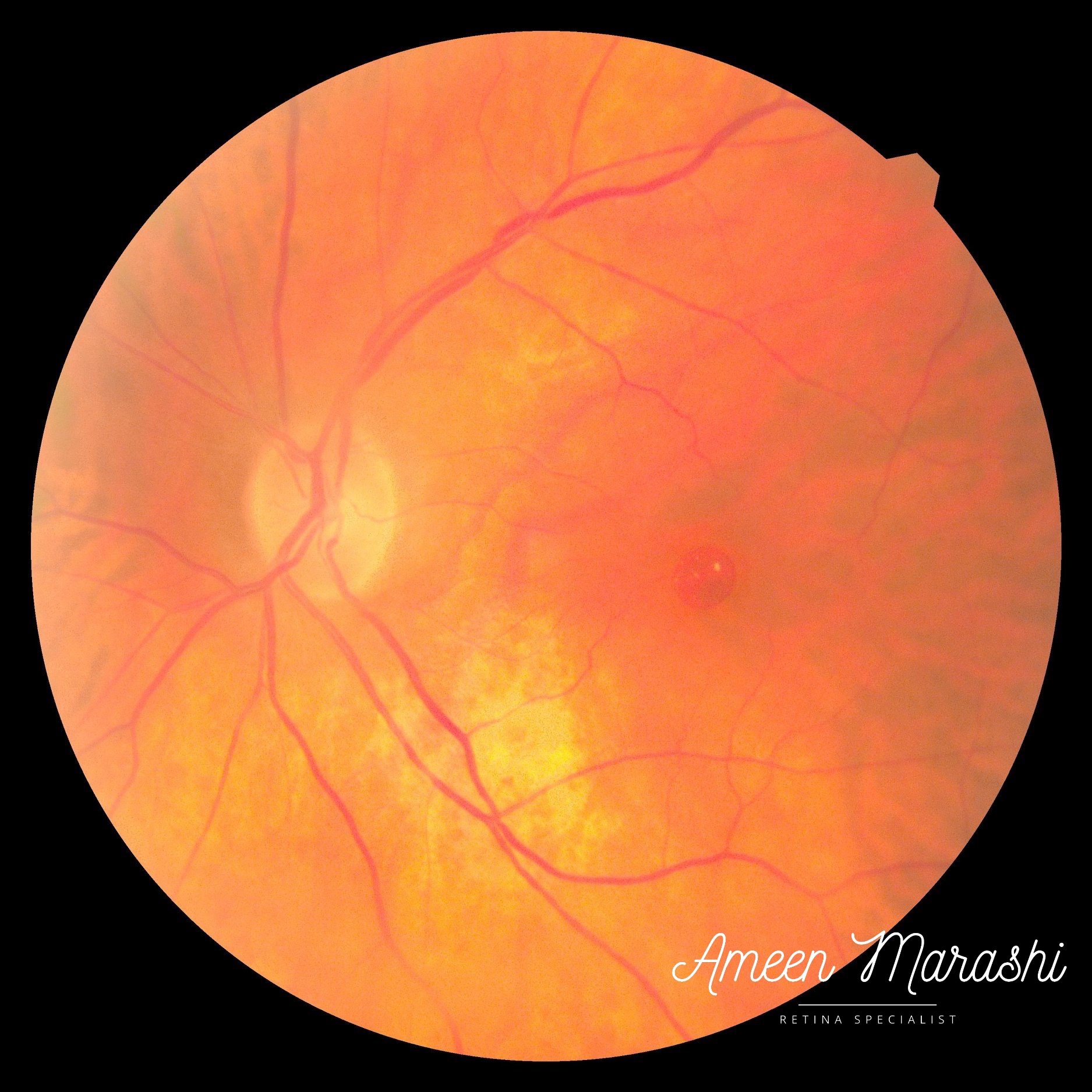 Full-thickness macular hole stage four