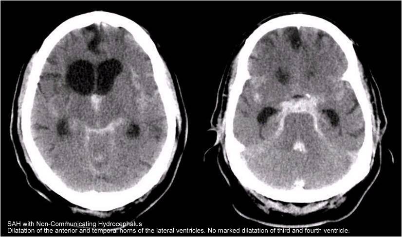 Dr Balaji Anvekar FRCR: Imaging in Sub Arachnoid H'rhage