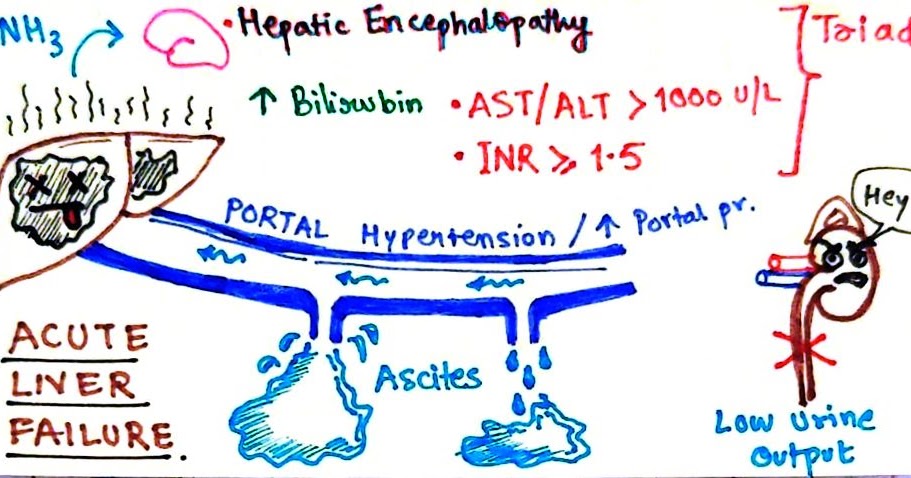 Medicowesome: Acute Liver Failure in a nutshell.