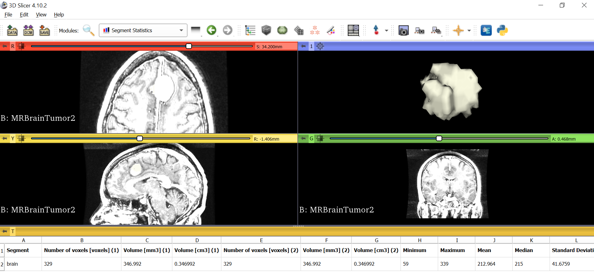 Everything Modelling and Simulation: Medical Image Segmentation with 3D ...