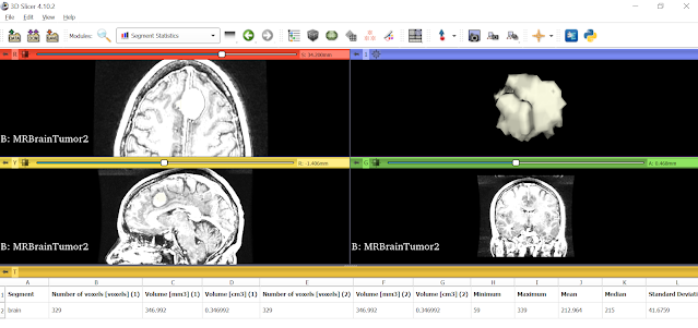 Everything Modelling and Simulation: Medical Image Segmentation with 3D ...