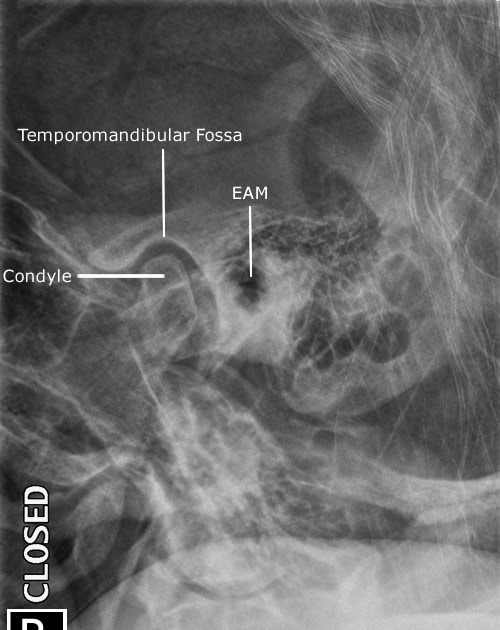 Radiology Anatomy Images Temporomandibular Joints Tmj Radiographic