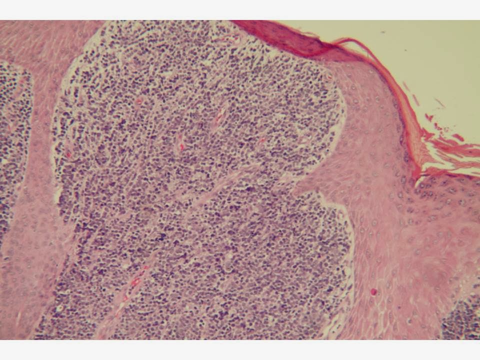 Dermpath Made Simple - Neoplastic: T and B cell lymphomas