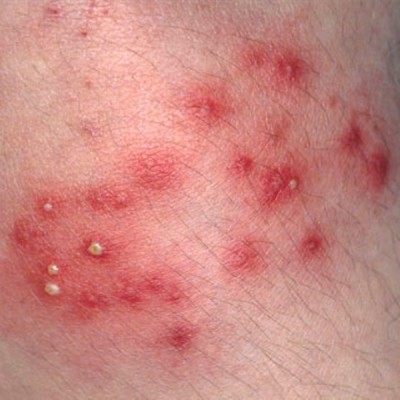 Pengertian dan Fungsi Radang (Respon Peradangan) | BagiTips