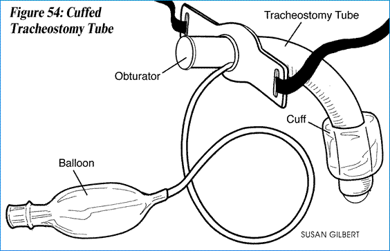 Tracheostomy Placement Diagram