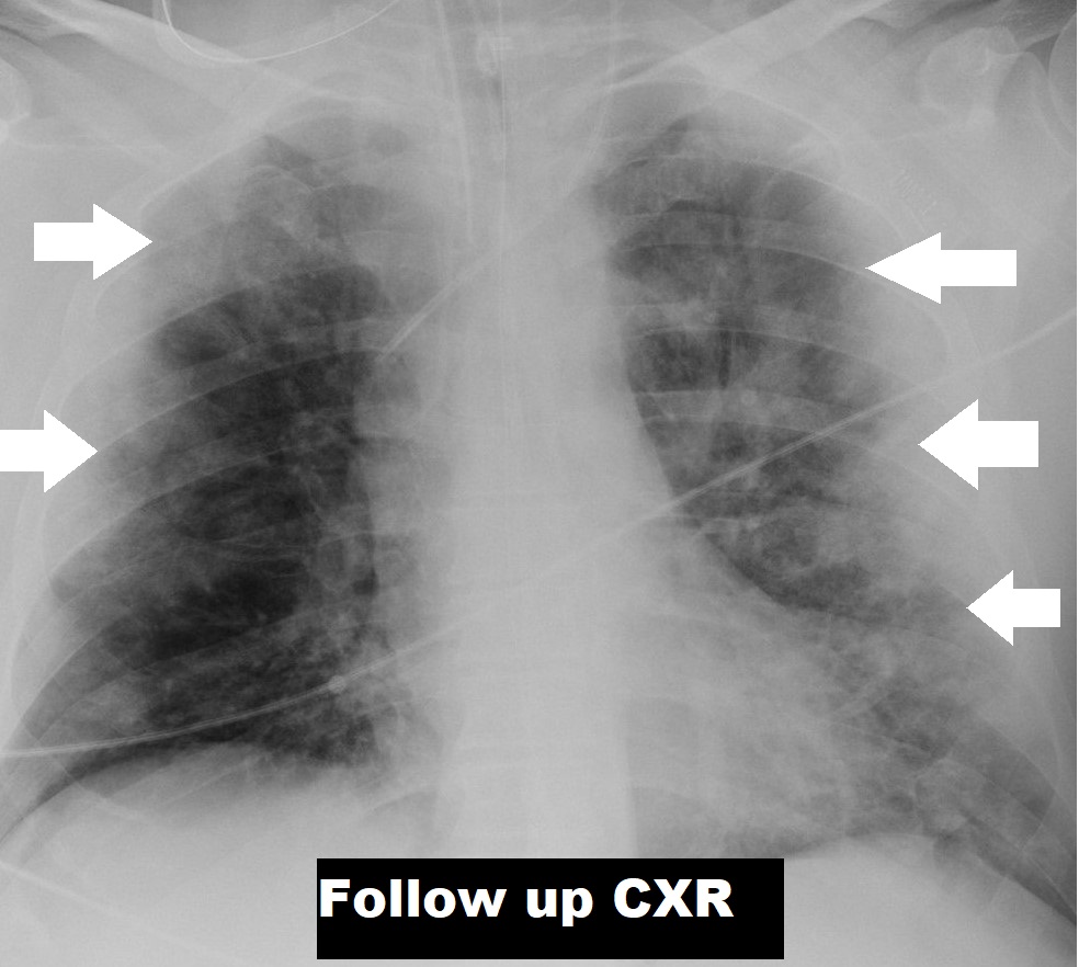 CXR in COVID19 - Sumer's Radiology Blog