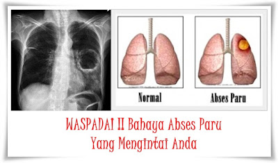 Cara Mengobati Abses Paru Pada Anak Secara Alami ~ Obat Herbal Alami