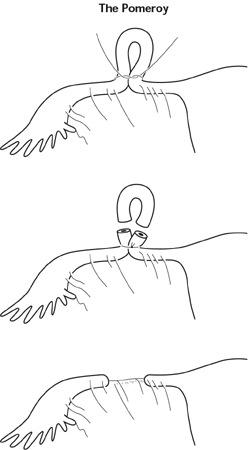 Obstetricia y Neonatologia: Salpingectomía