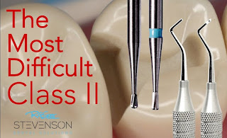 OPERATIVE DENTISTRY: Indirect Composite Restoration - Clinical Case