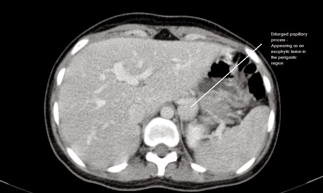 Ultimate Radiology : Pseudolesion : Papillary Process of Caudate Lobe