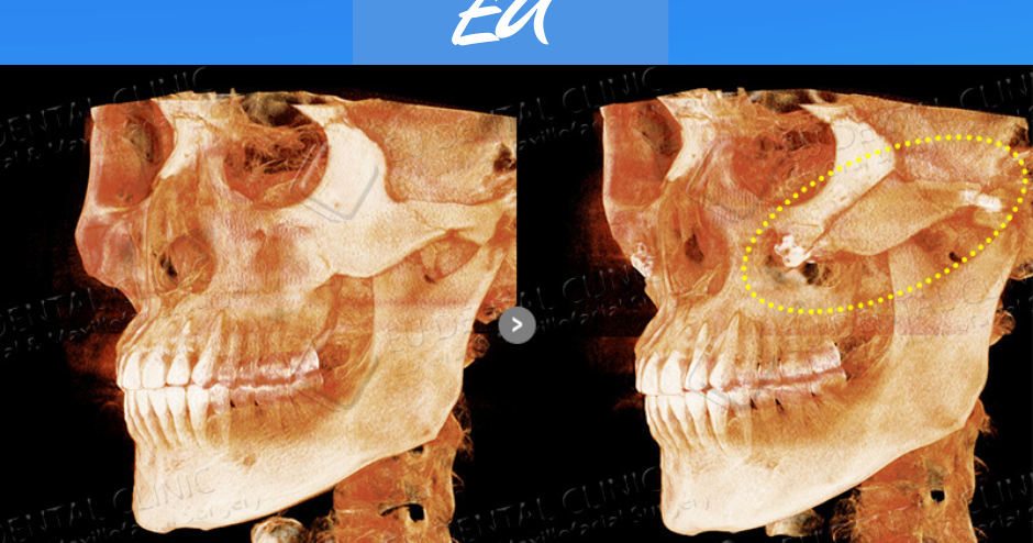 What is cheekbone reduction surgery?