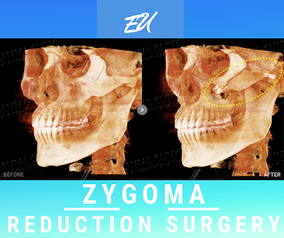 What is cheekbone reduction surgery?