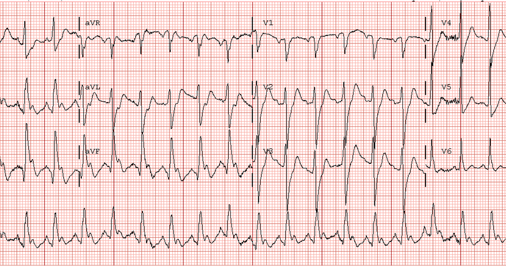 Dr. Smith's ECG Blog: Acute Cardiogenic Shock: What is the Diagnosis?