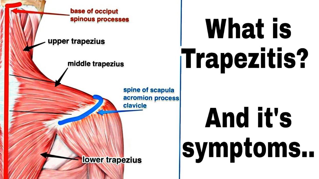 VASTRAL PHYSIOTHERAPY CLINIC: Trapezitis Pain : Physiotherapy Treatment